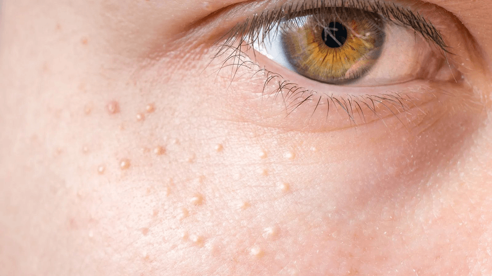 MILIA REMOVAL | The Doctor Edges