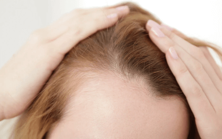 MODIFIED SCALP REDUCTION LOWER HAIRLINE | The Doctor Edges