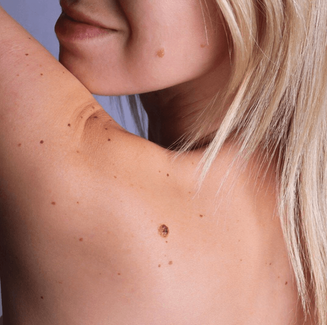 SEBORRHEIC KERATOSIS (SK) REMOVAL | The Doctor Edges